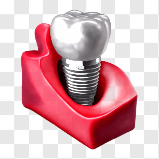 Dental Implant PNG - Download Free & Premium Transparent Dental Implant ...